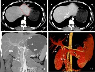 Multislice Computed Tomographic Manifestation of Transient Hepatic ...