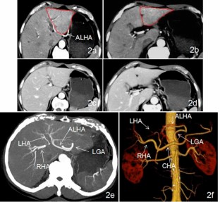 Multislice Computed Tomographic Manifestation of Transient Hepatic ...