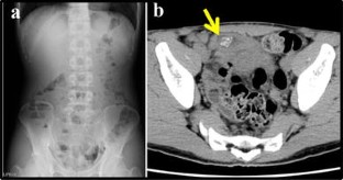 Retention of the cellophane wall of a patency capsule by intestinal ...