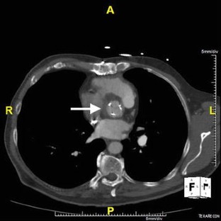 Diagnosis of peri-valvular abscess by FDG PET/CT imaging in a Bentall ...