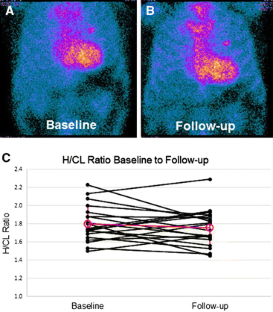 Serial scanning with technetium pyrophosphate ( 99m Tc-PYP) in advanced ...
