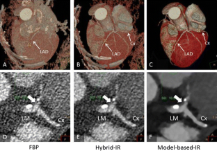 High Risk Plaque Features on Coronary CT Angiography | SpringerLink