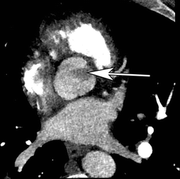 The Role of Cardiac CT in the Evaluation of Endocarditis | SpringerLink