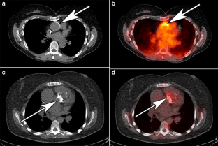 The Role of Cardiac CT in the Evaluation of Endocarditis | SpringerLink