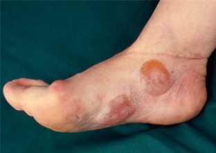 Veranderingen aan huid- en nagels bij de oudere voet | SpringerLink