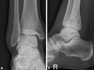 Enkelfracturen: gips of operatie na een enkelfractuur? | SpringerLink