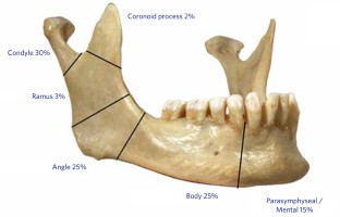 Collum mandibulae-fracturen: open versus gesloten behandeling ...