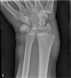 Radiocarpale luxatie | SpringerLink