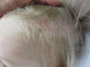 Childhood Langerhans cell histiocytosis: a disease with many faces ...