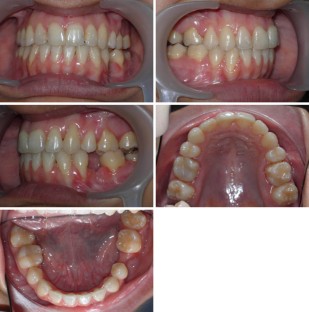 Posterior scissor bite and lateral open bite with missing lower first ...