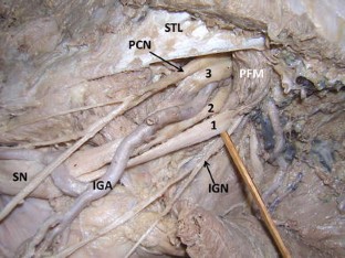 A sciatic nerve with three roots and its perforation by the enlarged ...