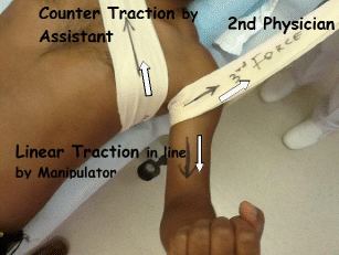 Shoulder dislocation—a modified reduction technique for anterior and ...
