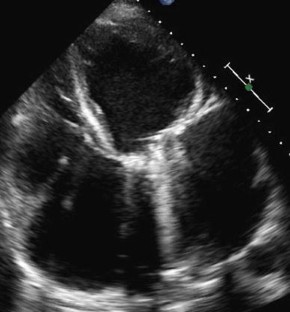 Severe dilated cardiomyopathy resulting in a globular cardiac ...