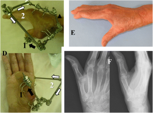 Correction of a Hyperextension Deformity at the Metacarpophalangeal ...
