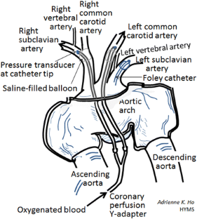Cannula malposition during antegrade cerebral perfusion for aortic ...