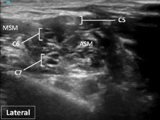 Refining the ultrasound-guided interscalene brachial plexus block: the ...