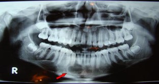 Traumatic Bone Cyst of Mandible | SpringerLink