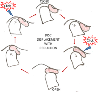 Temporomandibular Joint Arthrocentesis for Internal Derangement with ...