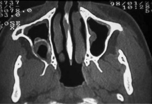 Keratocystic Odontogenic Tumor (KCOT/OKC)—Clinical Guidelines for ...