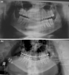Keratocystic Odontogenic Tumor (KCOT/OKC)—Clinical Guidelines for ...