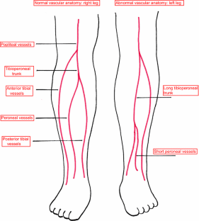 Successful Harvest of Free Fibula Flap in a Rare Anomalous Variant of ...