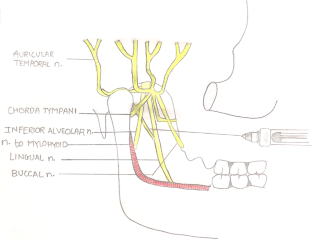 Vazirani–Akinosi Nerve Block Technique: An Asset of Oral and ...