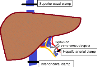 Liver resection under hypothermic total vascular exclusion | SpringerLink