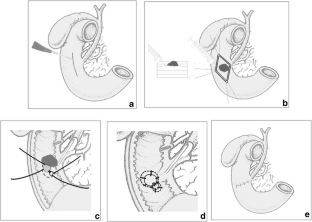 Transduodenal ampullectomy for ampullary tumors | SpringerLink