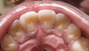 The Incisive Papilla: A Significant Landmark in Prosthodontics ...