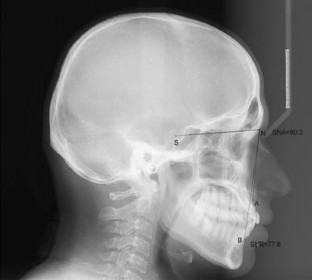 A Cephalometric Study on the Relationship Between the Occlusal Plane ...
