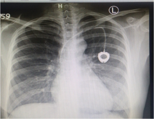 Catheter Fracture of Subclavian Venous Chemoport Device at ...