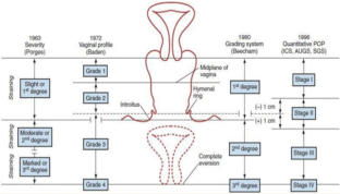 Relationship of Decubitus Ulcer on Cervix in Pelvic Organ Prolapse with ...