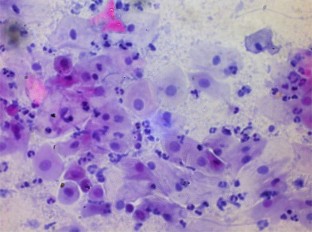 ASCUS (Atypical Squamous Cells of Undetermined Significance) in the ...