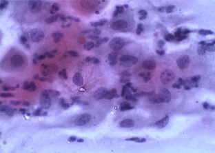 ASCUS (Atypical Squamous Cells of Undetermined Significance) in the ...