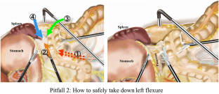 Laparoscopic resection of transverse colon cancer at splenic flexure ...