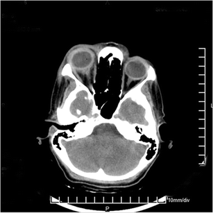 Endogenous panophthalmitis and diabetes | SpringerLink