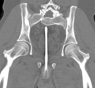 Urethral sounding: Een riskant seksspel | SpringerLink