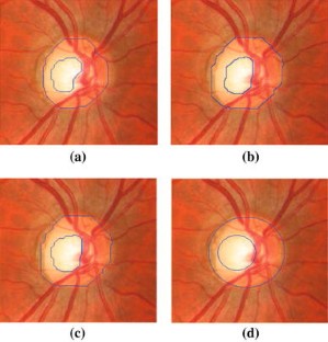 Diagnosis of glaucoma using CDR and NRR area in retina images ...