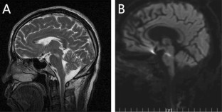 Caudal paramedian midbrain infarction: a clinical study of imaging ...