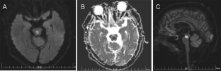 Caudal paramedian midbrain infarction: a clinical study of imaging ...