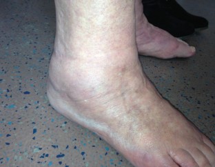 Diagnostik und Therapie der Peronealsehnenerkrankungen | SpringerLink