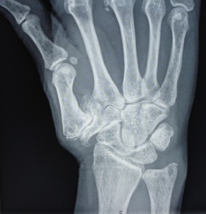 Stadiengerechte Rhizarthrose-Therapie | SpringerLink