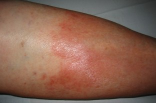 Erysipel: Wann wird es kritisch? | SpringerLink