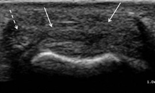 Ultrasound Imaging of the Hand and Wrist: Fundamentals and New ...