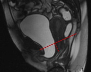 Magnetic Resonance Imaging of Female Pelvic Floor Dysfunction: A Review ...