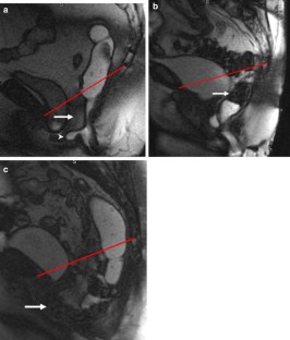 Magnetic Resonance Imaging of Female Pelvic Floor Dysfunction: A Review ...