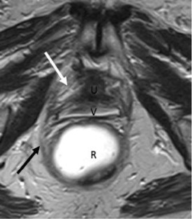 Magnetic Resonance Imaging of Female Pelvic Floor Dysfunction: A Review ...