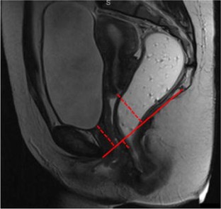 Magnetic Resonance Imaging of Female Pelvic Floor Dysfunction: A Review ...