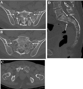 Fragility Fractures of the Pelvis: New Approaches to Classification and ...