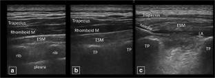 Erector Spinae Plane (ESP) Block: a New Paradigm in Regional Anesthesia ...